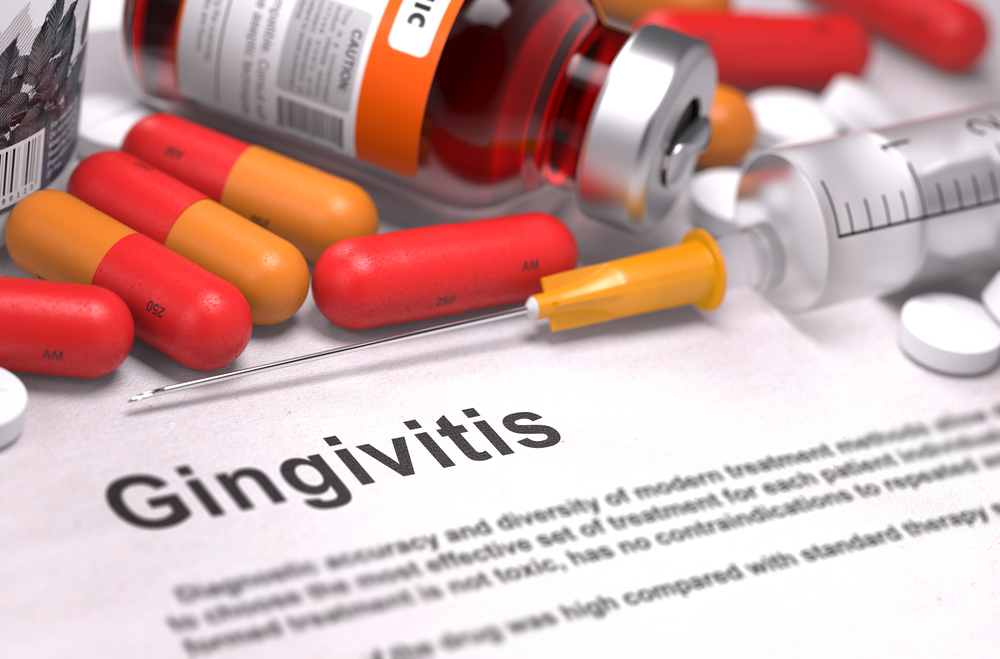 What Is Gingivitis?