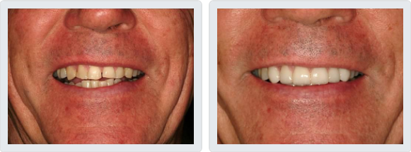 Porcelain Veneers Cost in Scottsdale Phoenix AZ Porcelain Veneers Cost in Scottsdale Phoenix AZ